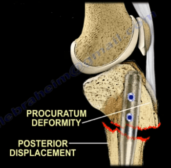 Intramedullary Nailing Proximal Tibial Fractures - medi...