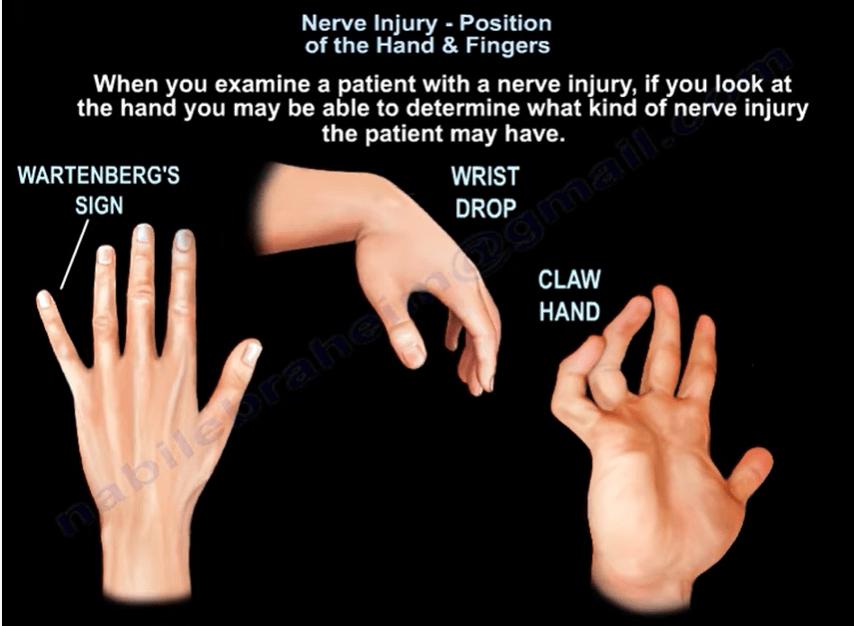 Nerve Injury Positions of the Hands and Fingers - nerve...