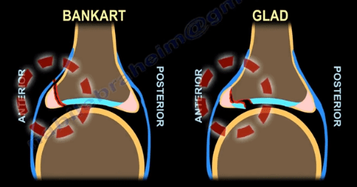 Lesions of the Shoulder- GLAD Lesion - lesions Healthca...