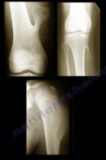 Osteochondroma - Healthcare genetics Orthopedic Surgery...