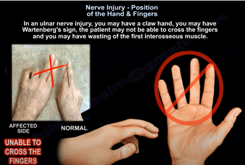 Nerve Injury Positions of the Hands and Fingers - nerve...