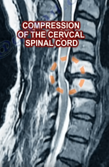 Cervical Myelopathy - Healthcare Nabil Ebraheim Orthope...