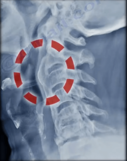 Diffuse Idiopathic Skeletal Hyperostosis - DISH Orthope...