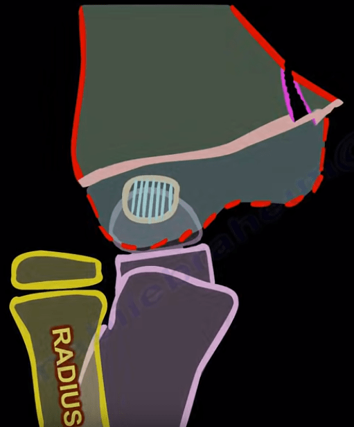 Pediatric Elbow Dislocation - Orthopedic Surgery Elbow ...