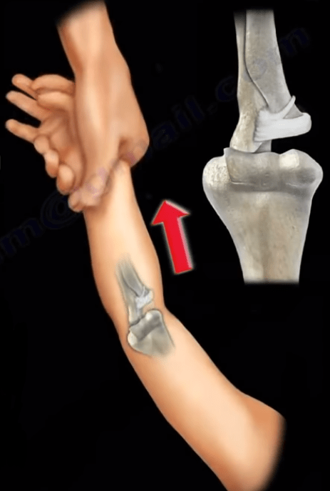 Pediatric Elbow Dislocation - Orthopedic Surgery Elbow ...