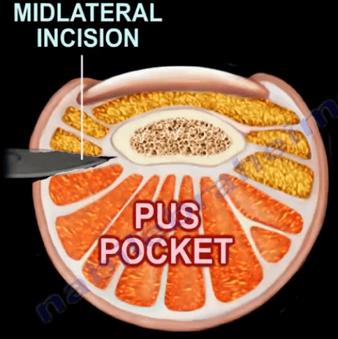 Felon - Bacteria Infections Orthopedics finger Healthca...