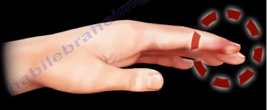 Felon - Bacteria Infections Orthopedics finger Healthca...