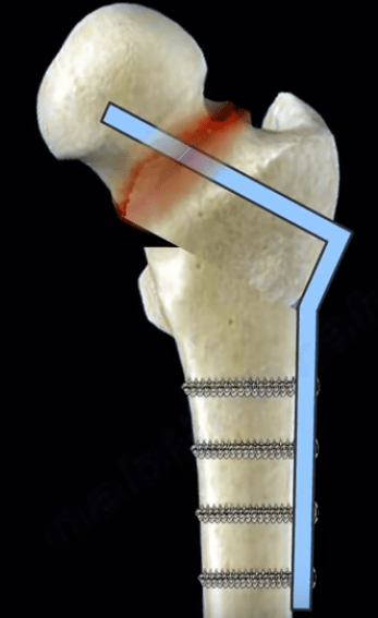 Femoral Neck Fracture - Orthopedics Hip Nonunion Health...