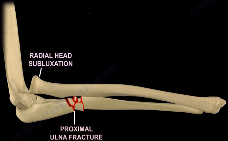fracture ulnar head