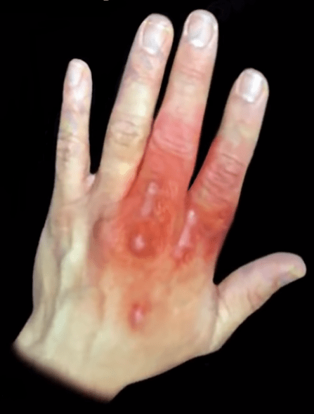 Mycobacterium Marinum - Infections Bacteria Skin Orthop...