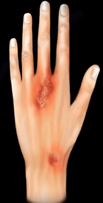 Mycobacterium Marinum - Infections Bacteria Skin Orthop...