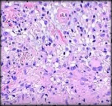 Mycobacterium Marinum - Infections Bacteria Skin Orthop...