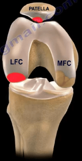 Knee Osteochondritis Dissecans, Wilson's Test - Healthc...