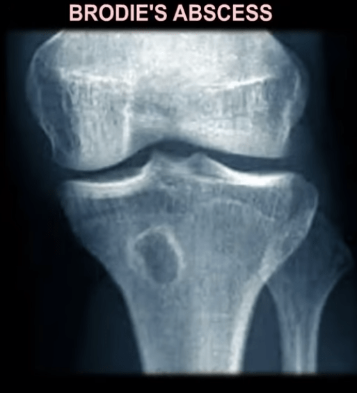 osteoid osteoma tibia