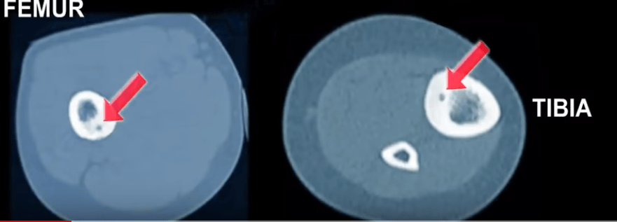 osteoid osteoma tibia ct