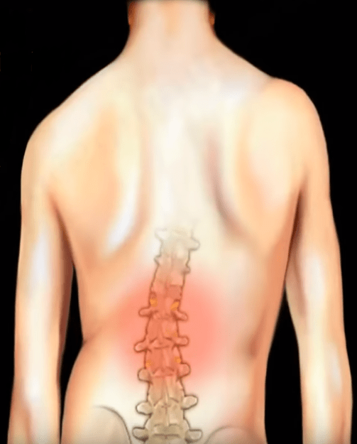 osteoid osteoma back
