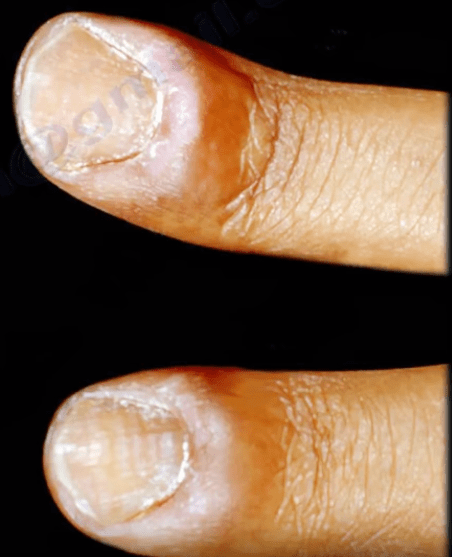 Paronychia - Orthopedics Nail Infections medicine Healt...