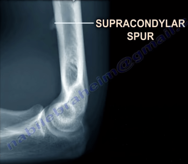 Pronator Teres Syndrome - Nerves Nabil Ebraheim Orthope...