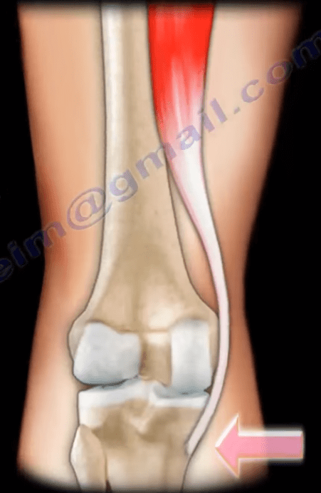 semitendinosus insertion