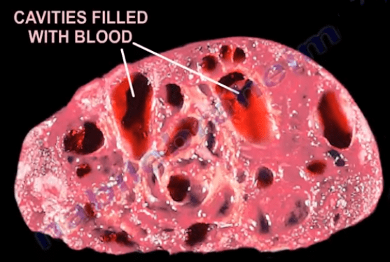 Unicameral Bone Cyst - Healthcare Orthopaedics Lesions ...