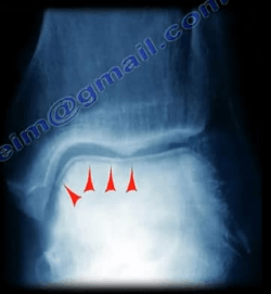 Osteonecrosis, AVN of the Talus - Healthcare Orthopaedi...