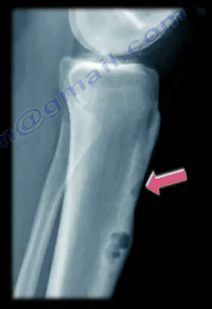 bony lump on tibia