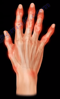 Arthritis of the Fingers - Healthcare Orthopedic Surger...