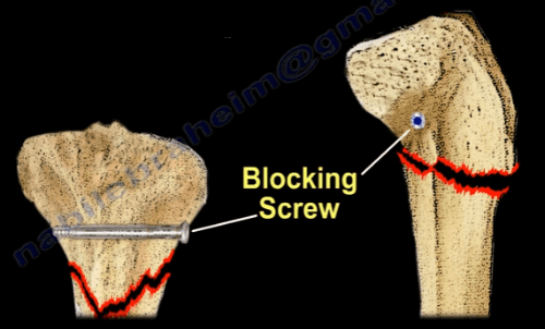 Intramedullary Nailing Proximal Tibial Fractures - medi...