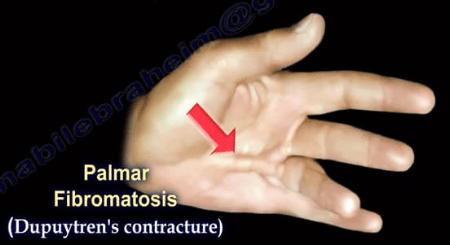Plantar Fascia-Fibromatosis - Foot pain Plantar fasciit...