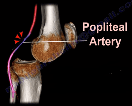 Knee Dislocations - knee knee injury Orthopaedics Ortho...
