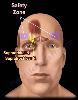 Complications Of The Halo Brace - Nabil Ebraheim medici...