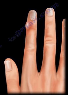 Arthritis of the Fingers - Healthcare Orthopedic Surger...