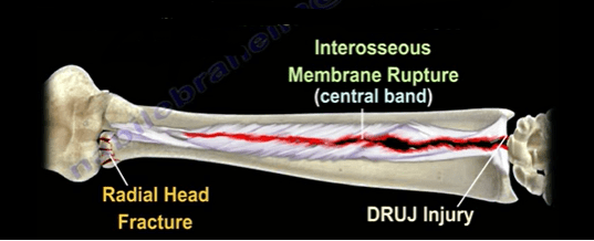 interosseous membrane tear