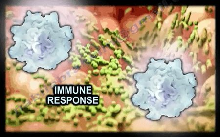 Reiter's Syndrome - medicine Healthcare Nabil Ebraheim