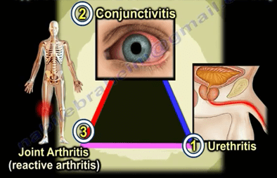 Reiter's Syndrome - medicine Healthcare Nabil Ebraheim