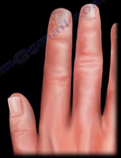 Arthritis of the Fingers - Healthcare Orthopedic Surger...