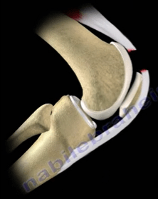 Quadriceps Tendon Rupture - Healthcare medicine quadric...