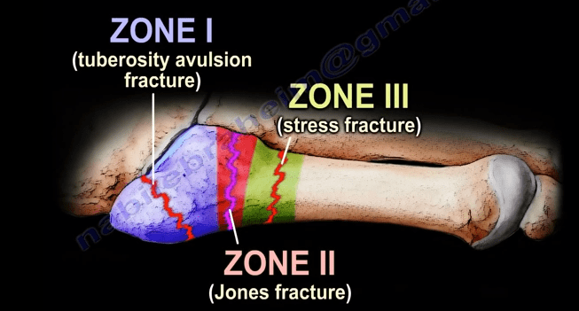 Jones Fracture - Healthcare Jones fracture Orthopedic S...